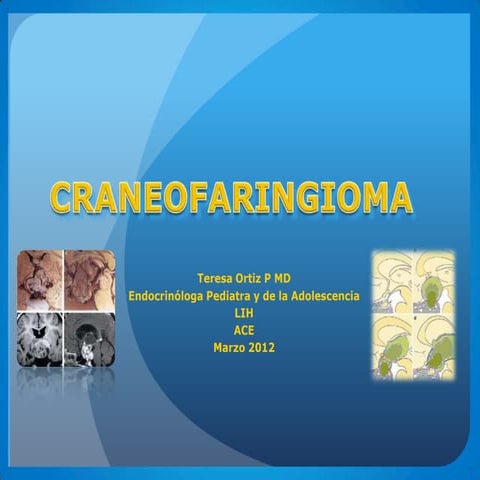 Craneofaringioma | PPTX