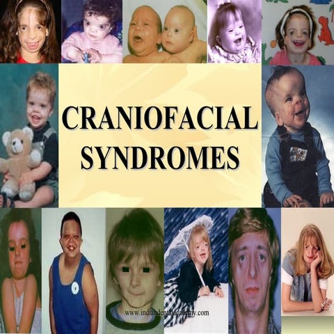 Craniofacial syndromes /certified fixed orthodontic courses by Indian ...