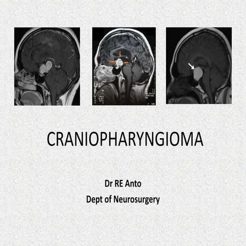 Craniopharyngioma | PPTX
