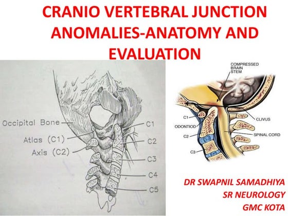 Craniovertebral anomalies | PPT