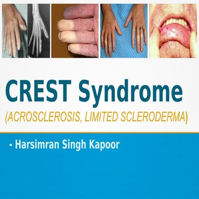 Crest Syndrome Scleroderma Basic Science Orthobullets