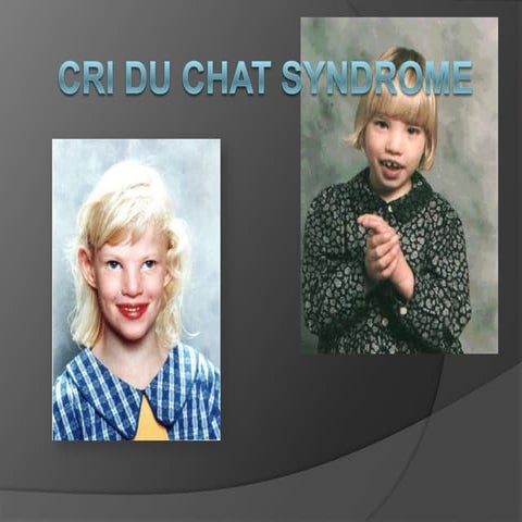 Cri du chat syndrome | PPT