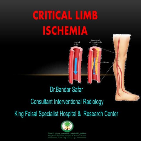 Critical limb ischemia kfsh | PPTX