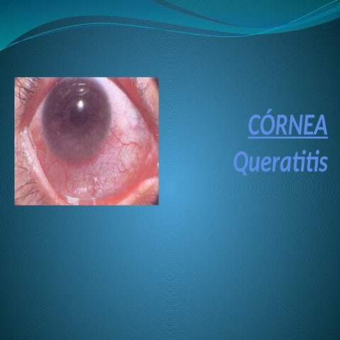CÓRNEA Queratitis-2 ABORDAJE Y TRATAMIENTO .pptx
