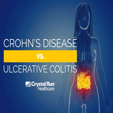 Crohn's Disease vs. Ulcerative Colitis | PDF