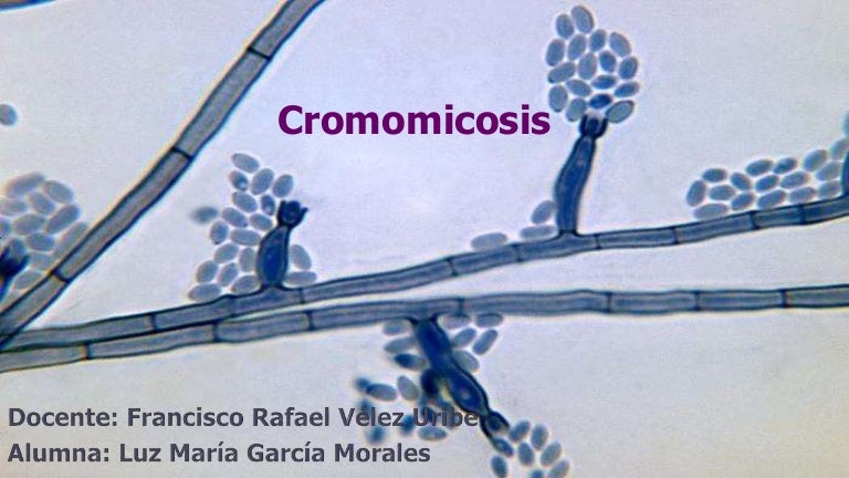 Cromomicosis (1)