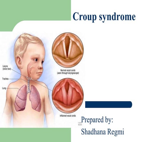 Croup syndrome.pptx