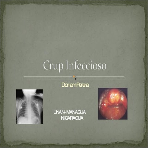 LARINGOTRAQUEITIS EN PEDIATRIA Y FISIOPATOLOGIA. PDF | PDF