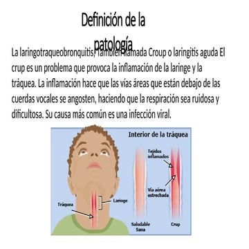 Crup también llamada laringotraqueobronquitis .pptx