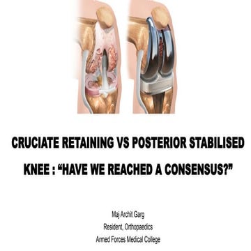 CRUCIATE RETAINING VS POSTERIOR STABILISED KNEE : “HAVE WE REACHED A ...
