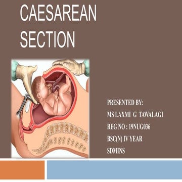 Caesarean section | PPTX
