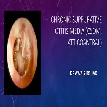 CSOM atticoantral.pptx