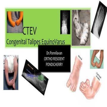 Radiographic assessment of pediatric foot alignment | PPTX