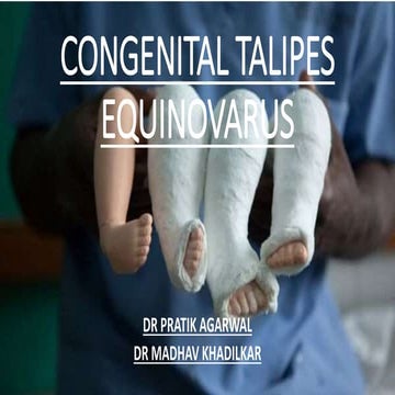 Congenital talipes equinovarus (club foot/ctev) ppt by Dr Pratik | PPTX