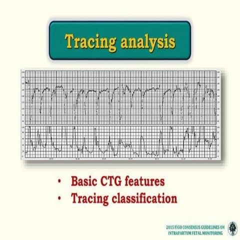 FIGO 2015 INTRAPARTUM MONITORING CTG CTG | PPTX