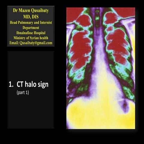 Ct halo sign (part 1) | PPTX