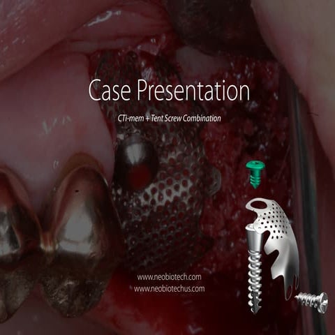 CTi-mem case presentation | PDF