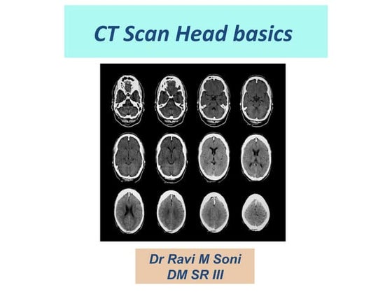 Basic reading computed tomography (ct) of brain | PPT