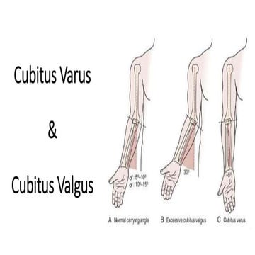 Cubitus valgus varus | PPTX