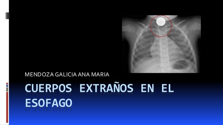 Cuerpos extraños en el esofago