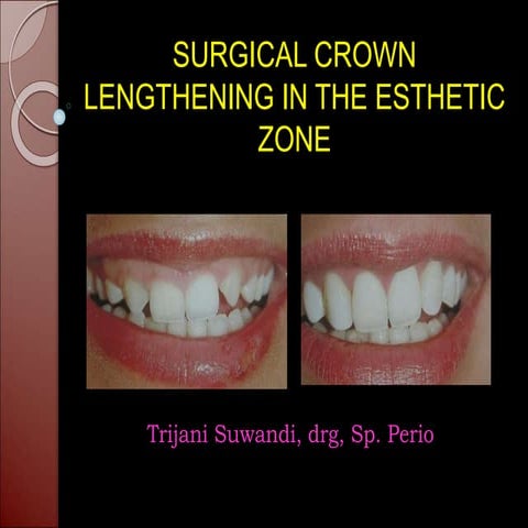 cupdf.com_surgical-crown-lengthening.ppt
