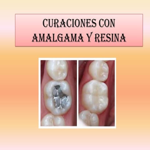 Curaciones con amalgama y resina | PPTX