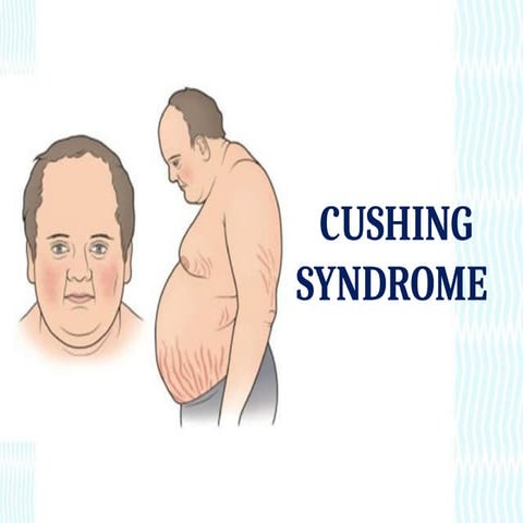 Cushings syndrome - endocrinology ppt... | PPTX