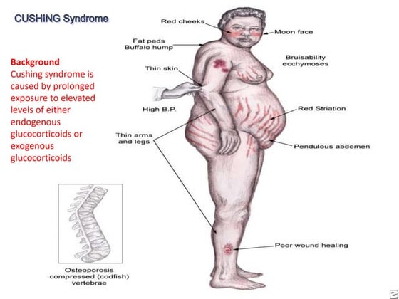 CUSHING SYNDROME.pptx