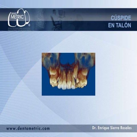 Cuspide en talon | PPTX
