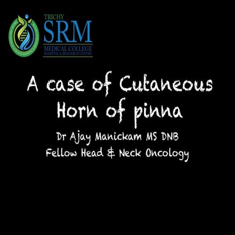 Acute otitis media | PPTX