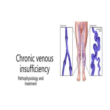 Chronic Venous insufficiency Overview.pptx