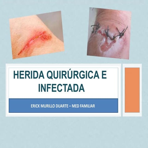 INFECCION HERIDA QUIRURGICA | PPT