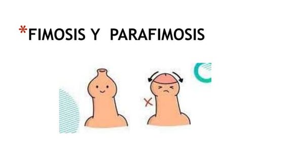 Fimosis y parafimosis | PPT