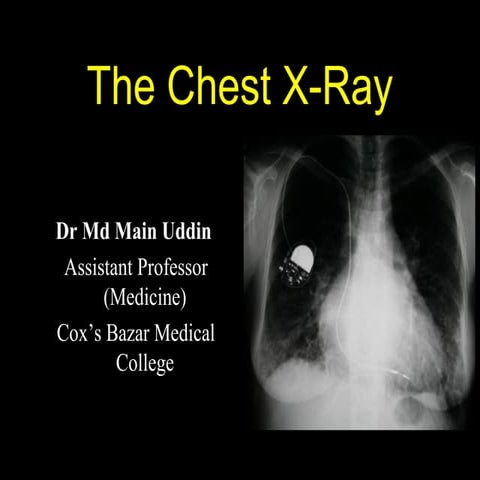 Interpretation of Chest X-Ray PPT | PPT