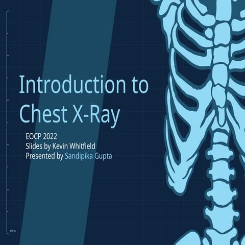 X Ray: Chest-Homogenous opacity | PPTX