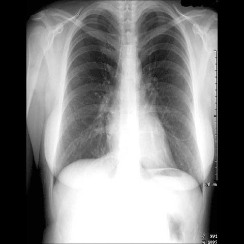 Cxr for final_year | PPT
