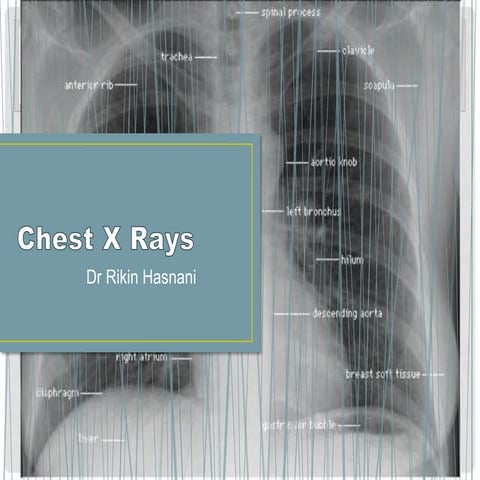 Chest x ray - basics | PPTX