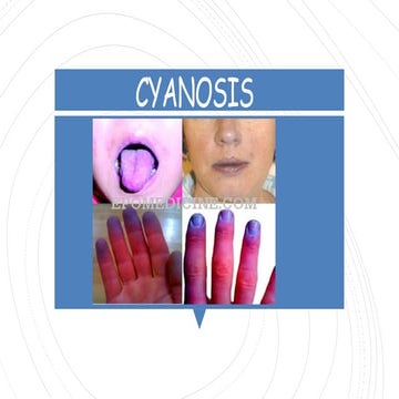 CYANOSIS powerpoint gddjdhj 20246197.pptm.pptx