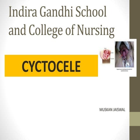 CYCTOCELE | PPTX