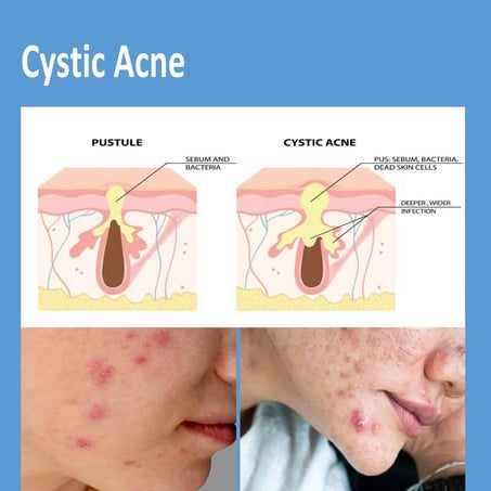 Cystic Acne Dermatologist Approved Guide To Treating Pdf