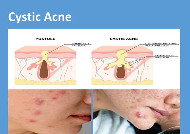 Cystic Acne Dermatologist Approved Guide To Treating Pdf