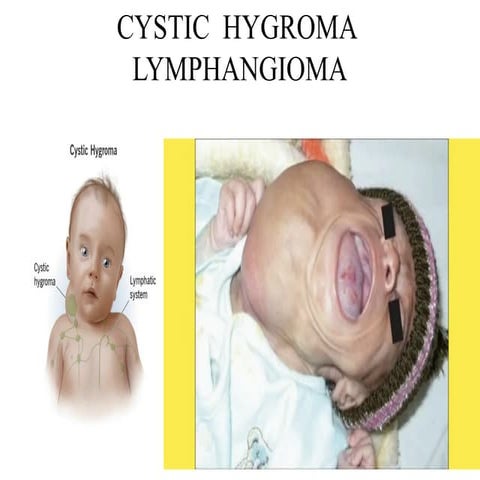 CYSTIC HYGROMA FOR CHILDREN AND ADULTING | PPTX