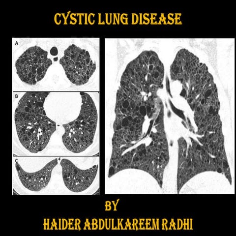 Cystic lung disease | PPTX