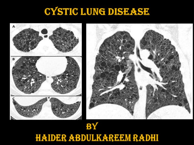 Differential diagnosis of pulmonary cyst: 1. Bullous Emphysema. 2 ...