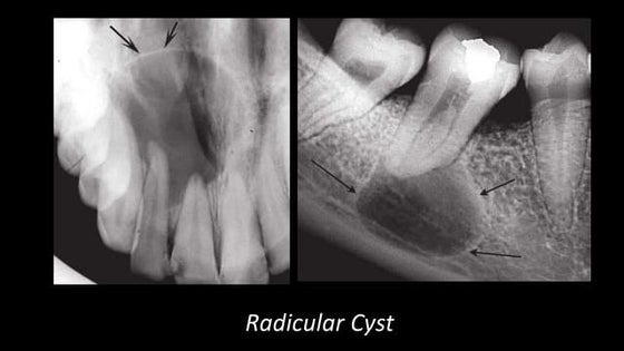 Radiological features in bone tumors | PPT