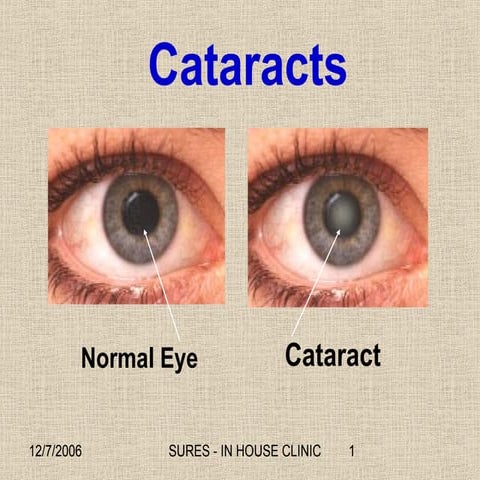 cataract-information | PPS