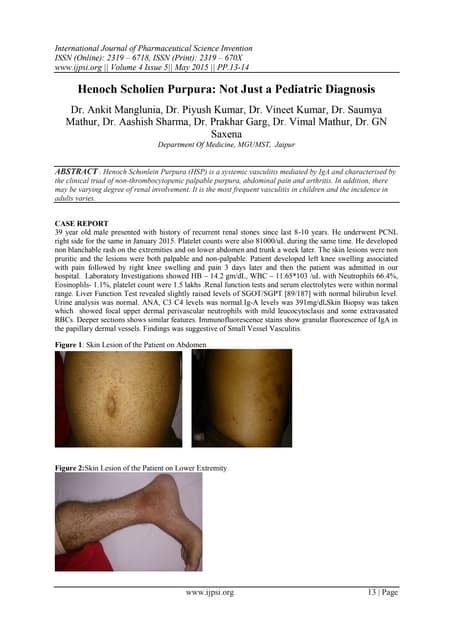 Henoch Schonlein Purpura HSP Case Report | PDF