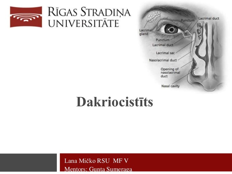 Dakriocistīts.