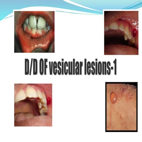 DD vesicular lesions.ppt