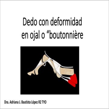 Dedo con deformidad en ojal o “boutonnière” | PDF